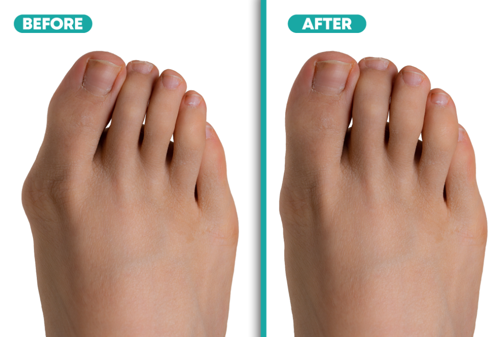 Bunion - Vargas Foot and Ankle Specialists