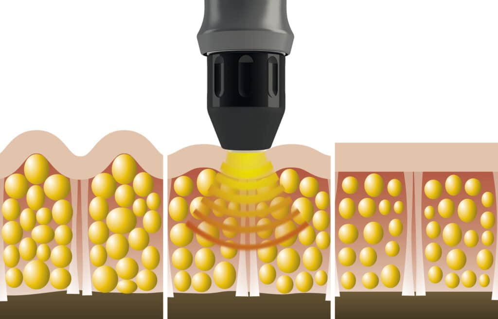 Revolutionizing Foot And Ankle Care With EPAT Therapy At Vargas Foot Revolutionizing Foot And Ankle Care With EPAT Therapy At Vargas Foot