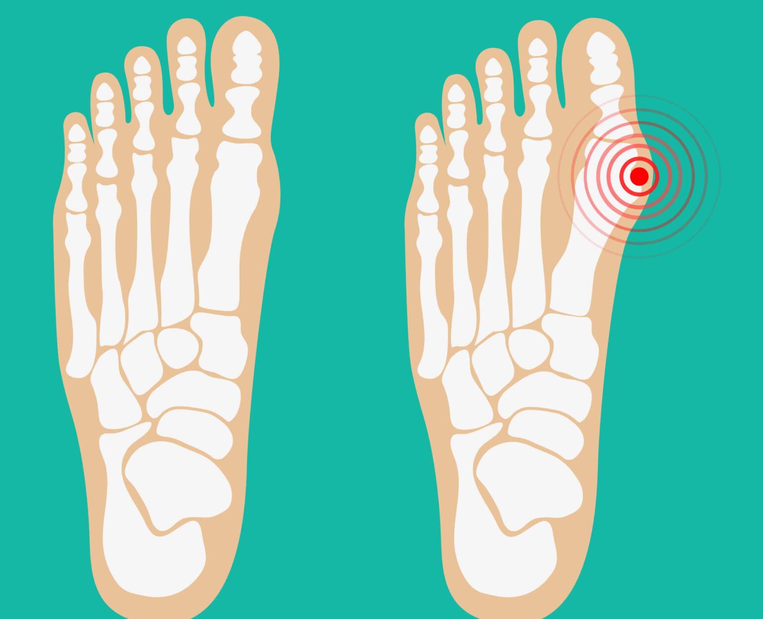 Bunions: How to Prevent Overlapping Toes | Dr. vargas
