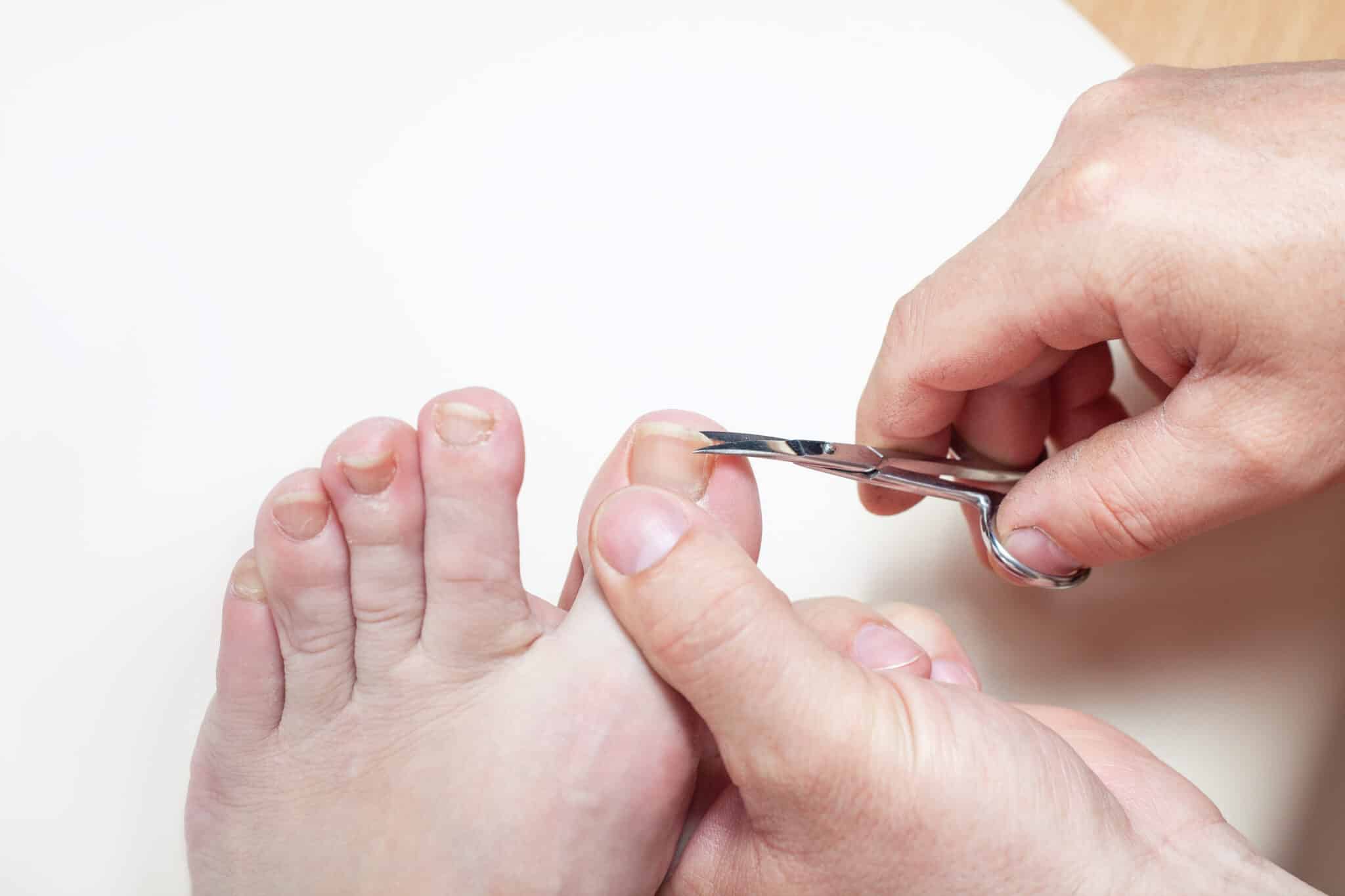 How to Stop Ingrown Toenails: Prevention and Treatment Tips