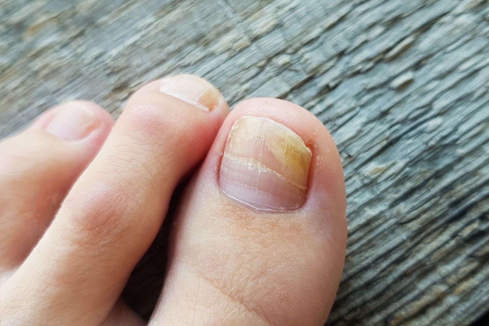 Toenails fungus- Vargas Foot Specialists